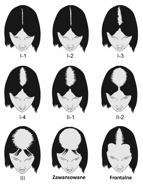 ysienie Androgenowe U Kobiet I M czyzn Hair Medica Klinika W os w ysienie Androgenowe U Kobiet I M czyzn Hair Medica Klinika W os w